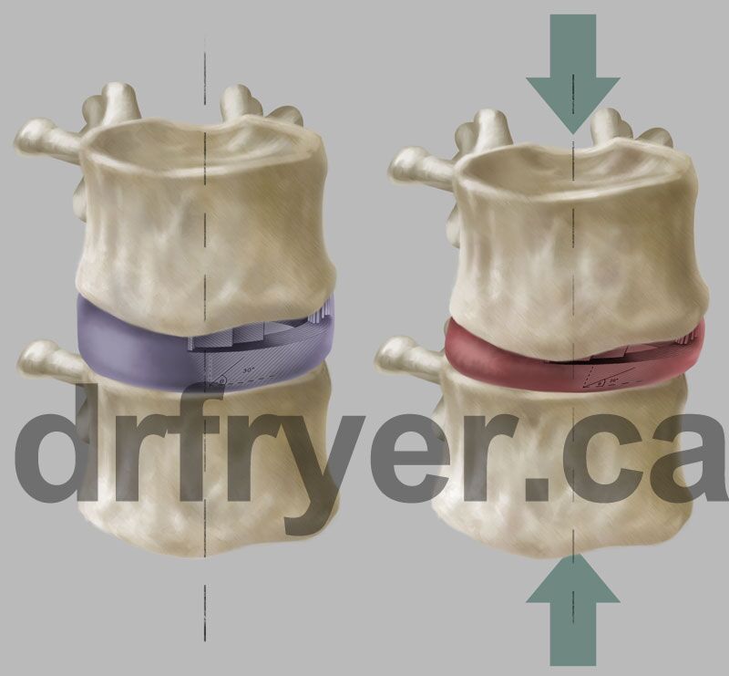 Disc Height Loss and Instability